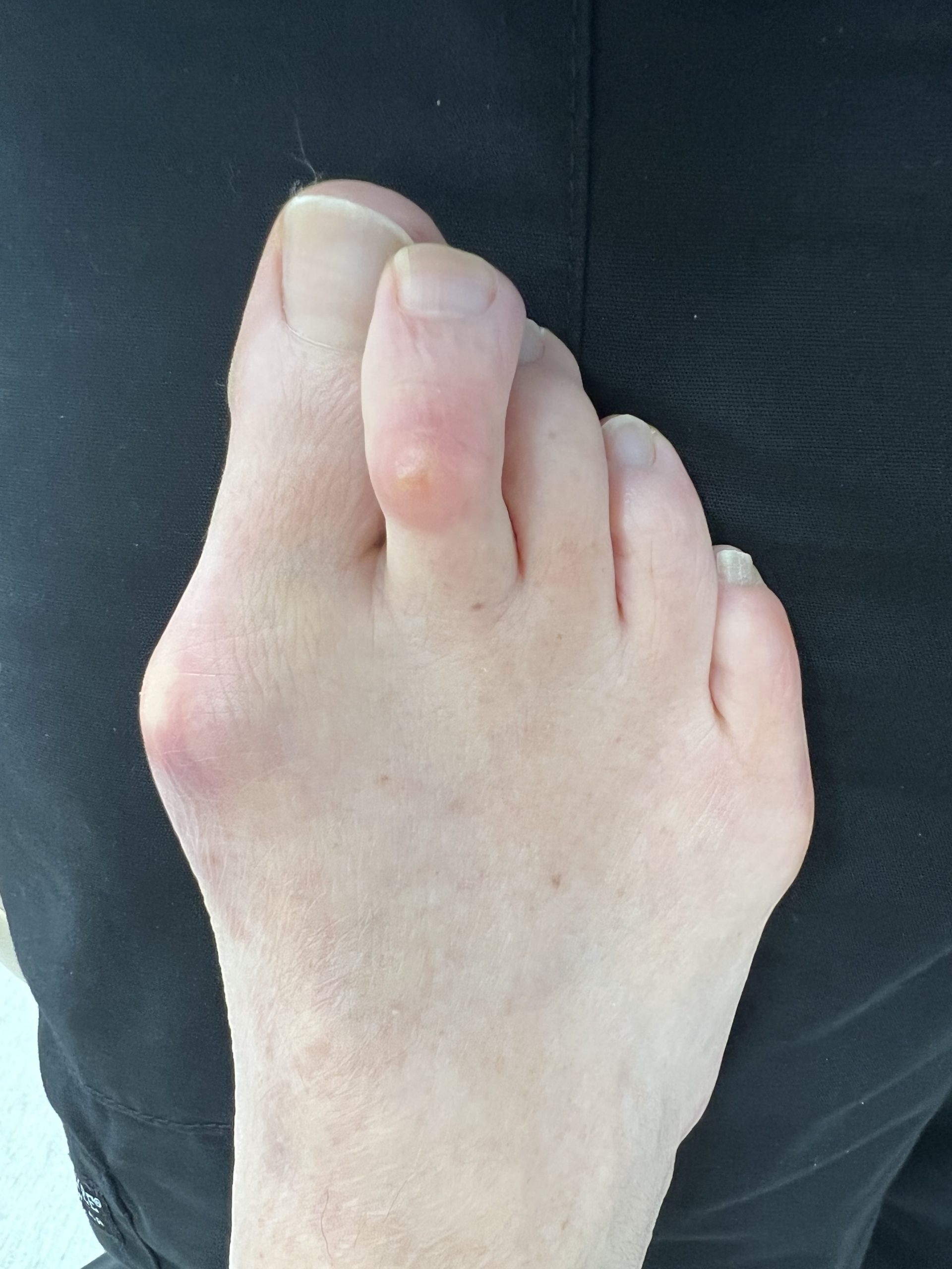 Bunion Before and After Photos | Northwest Surgery Center
