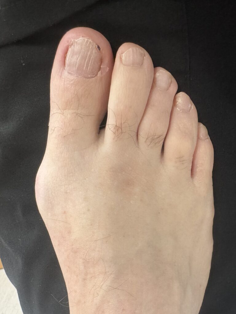 Bunion Before and After Photos | Northwest Surgery Center