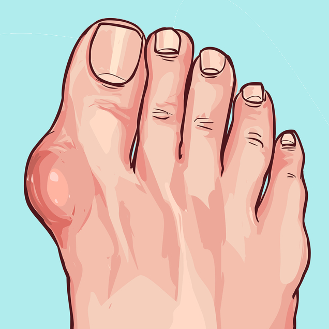 Bunionectomy | Northwest Surgery Center | Milwaukee, WI