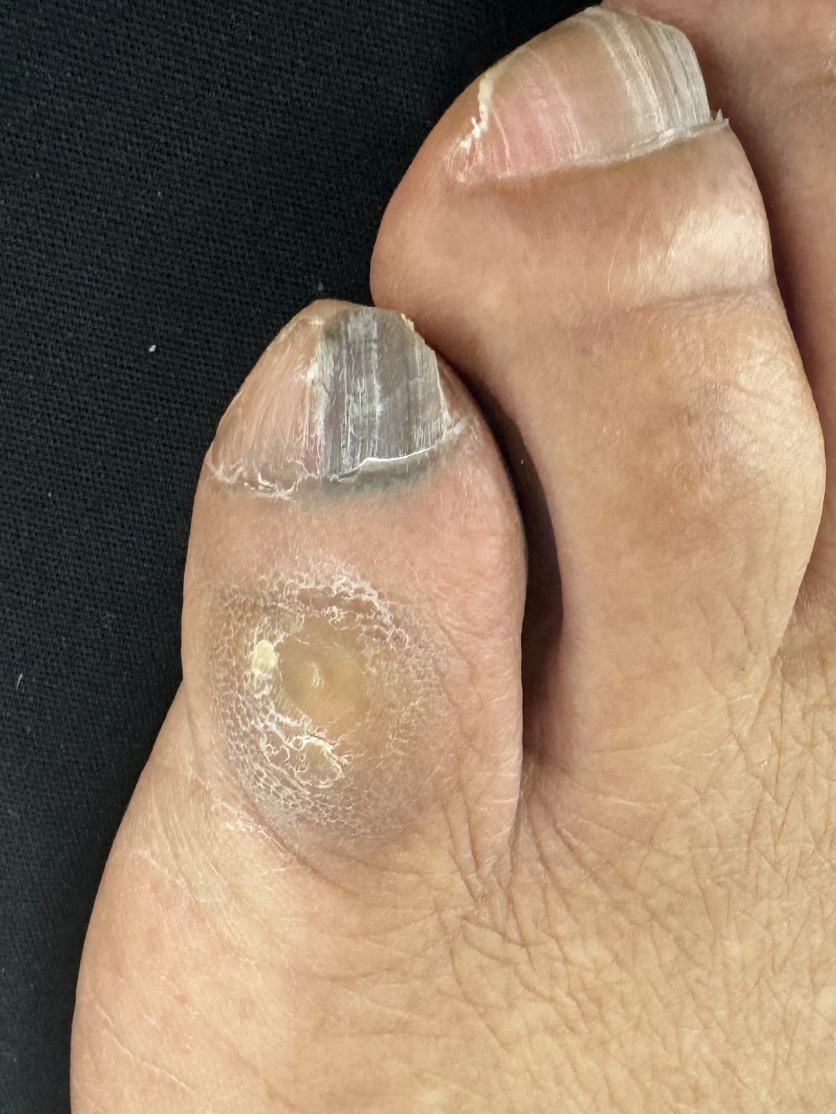 Corn and Callus Before and After Photos | Northwest Surgery Center