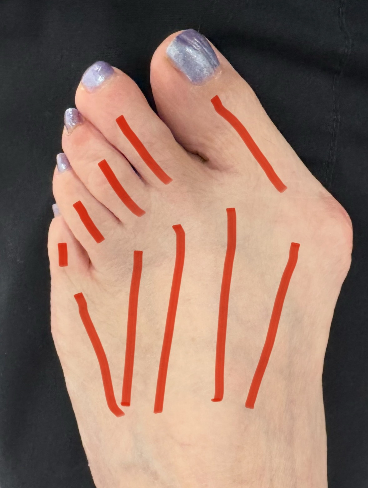 Tailor's Bunion Before and After Photos | Northwest Surgery Center