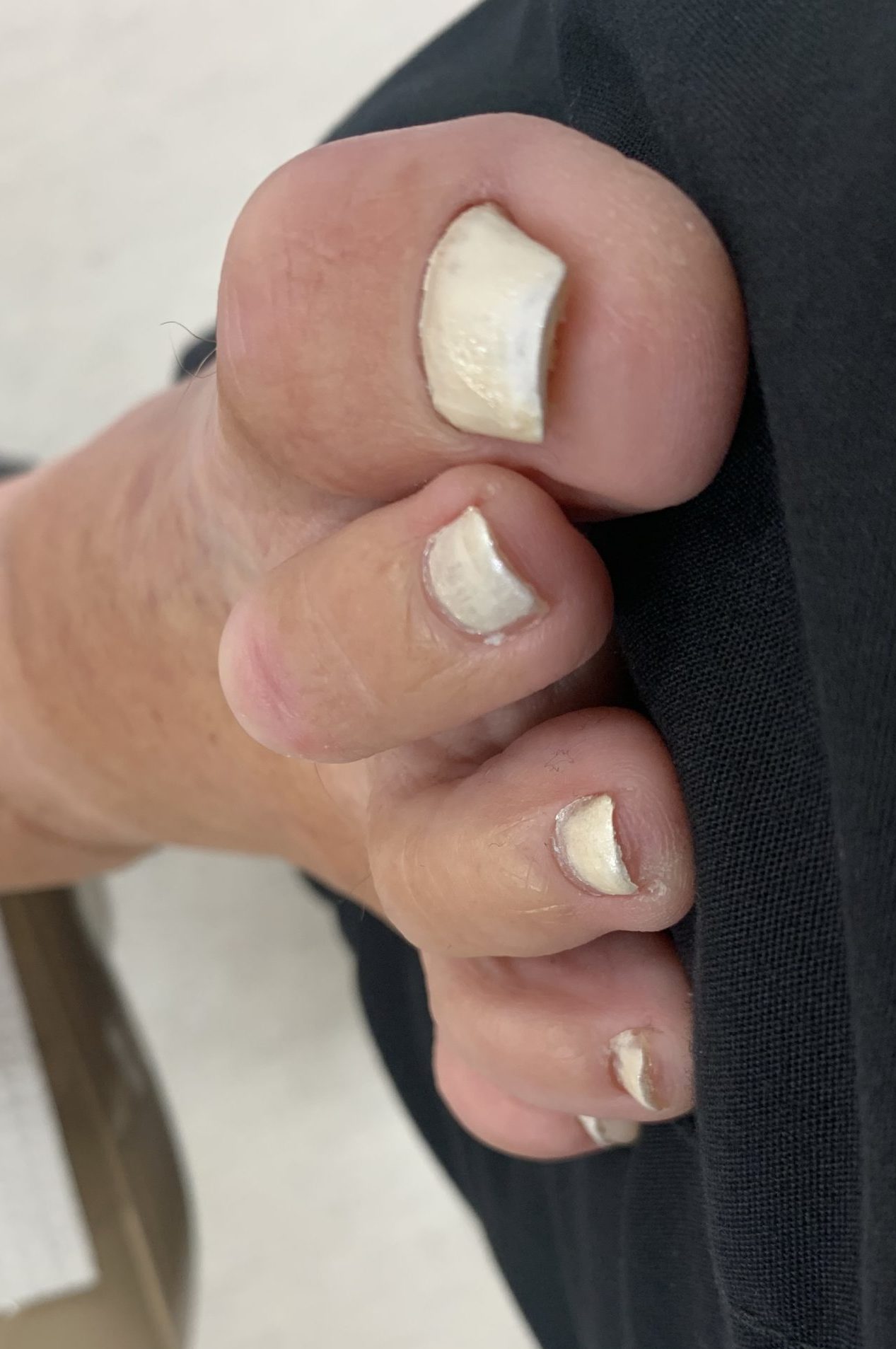 Bunion Before and After Photos | Northwest Surgery Center