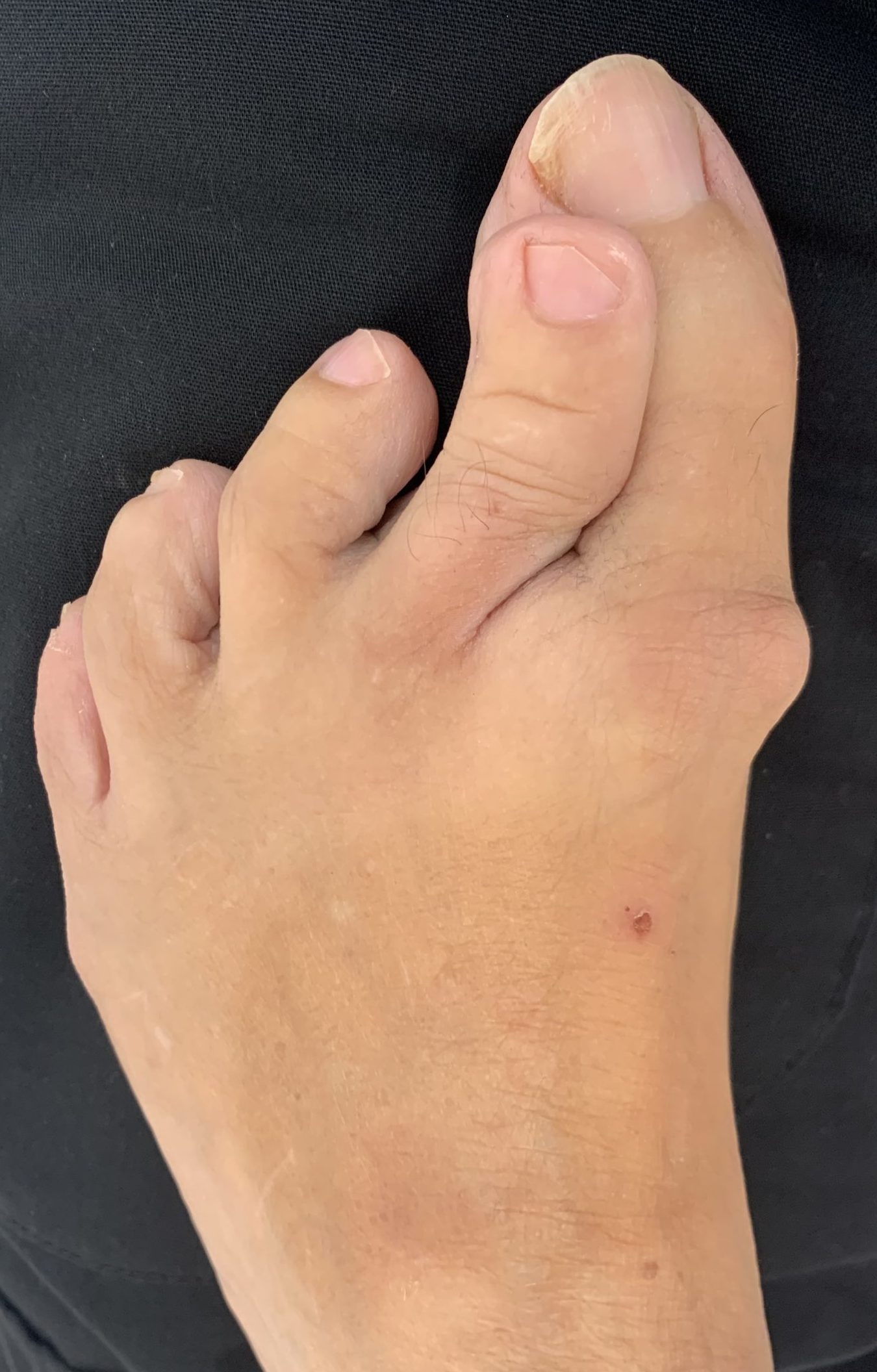 Severe Bunion Before and After Photos | Northwest Surgery Center