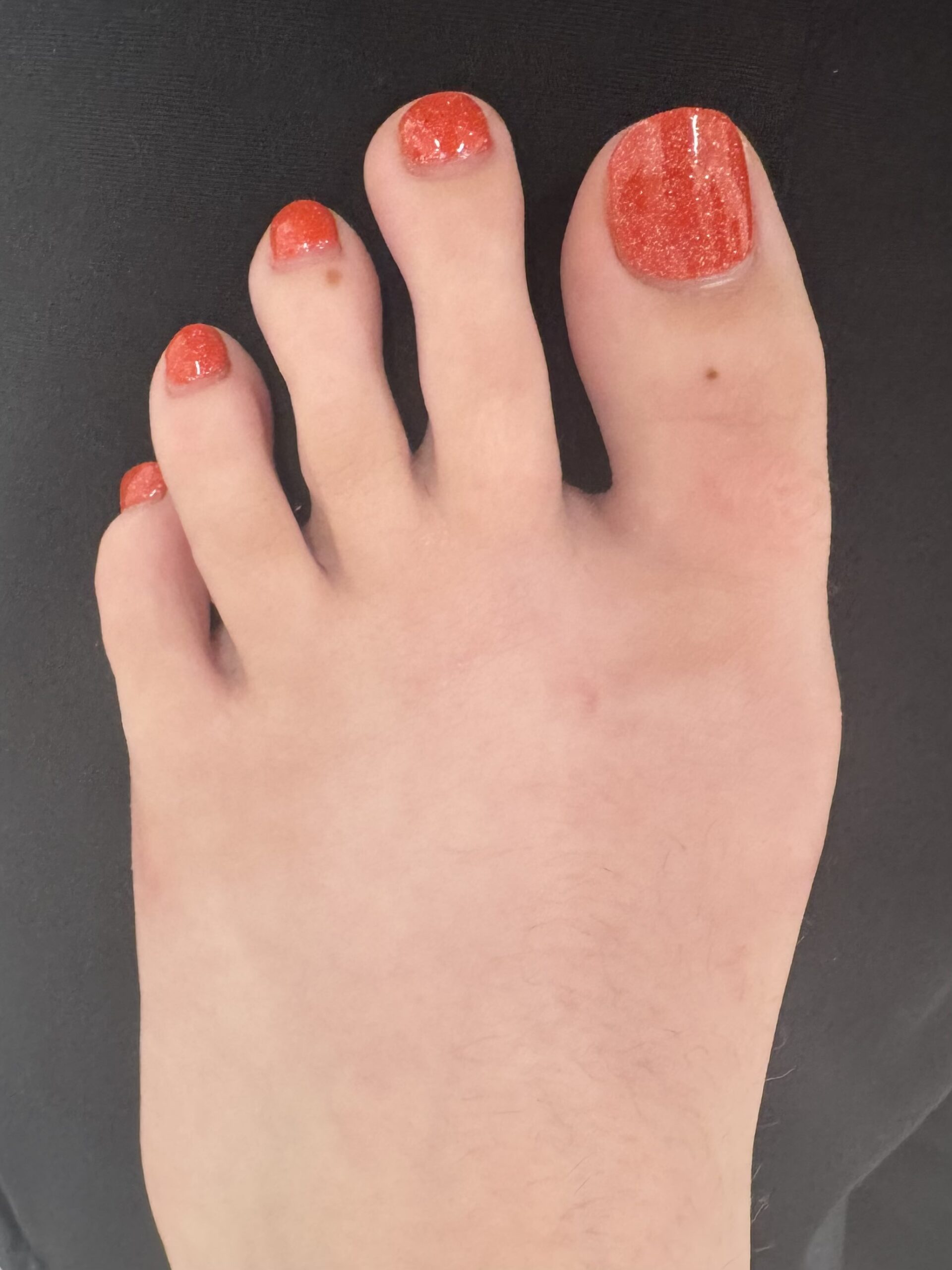 Mild Bunion Before and After Photos | Northwest Surgery Center