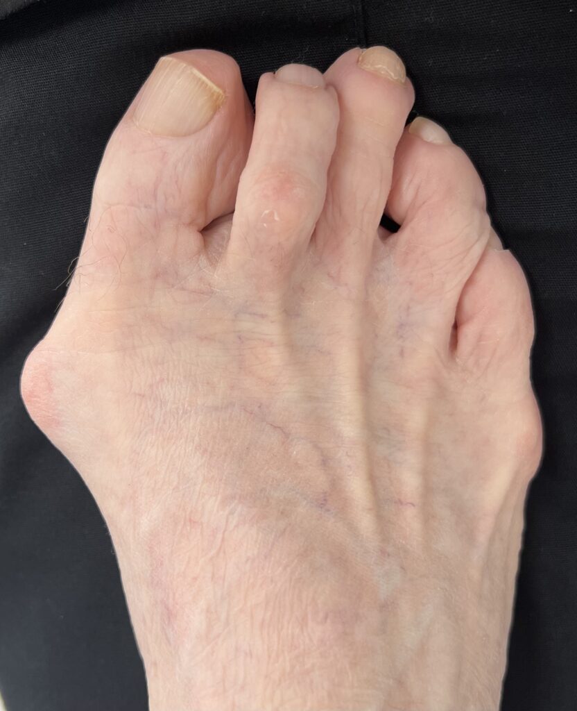 Severe Bunion Before and After Photos | Northwest Surgery Center