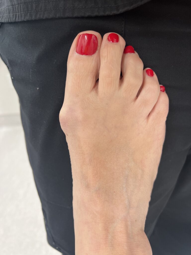 Bunion Before and After Photos | Northwest Surgery Center