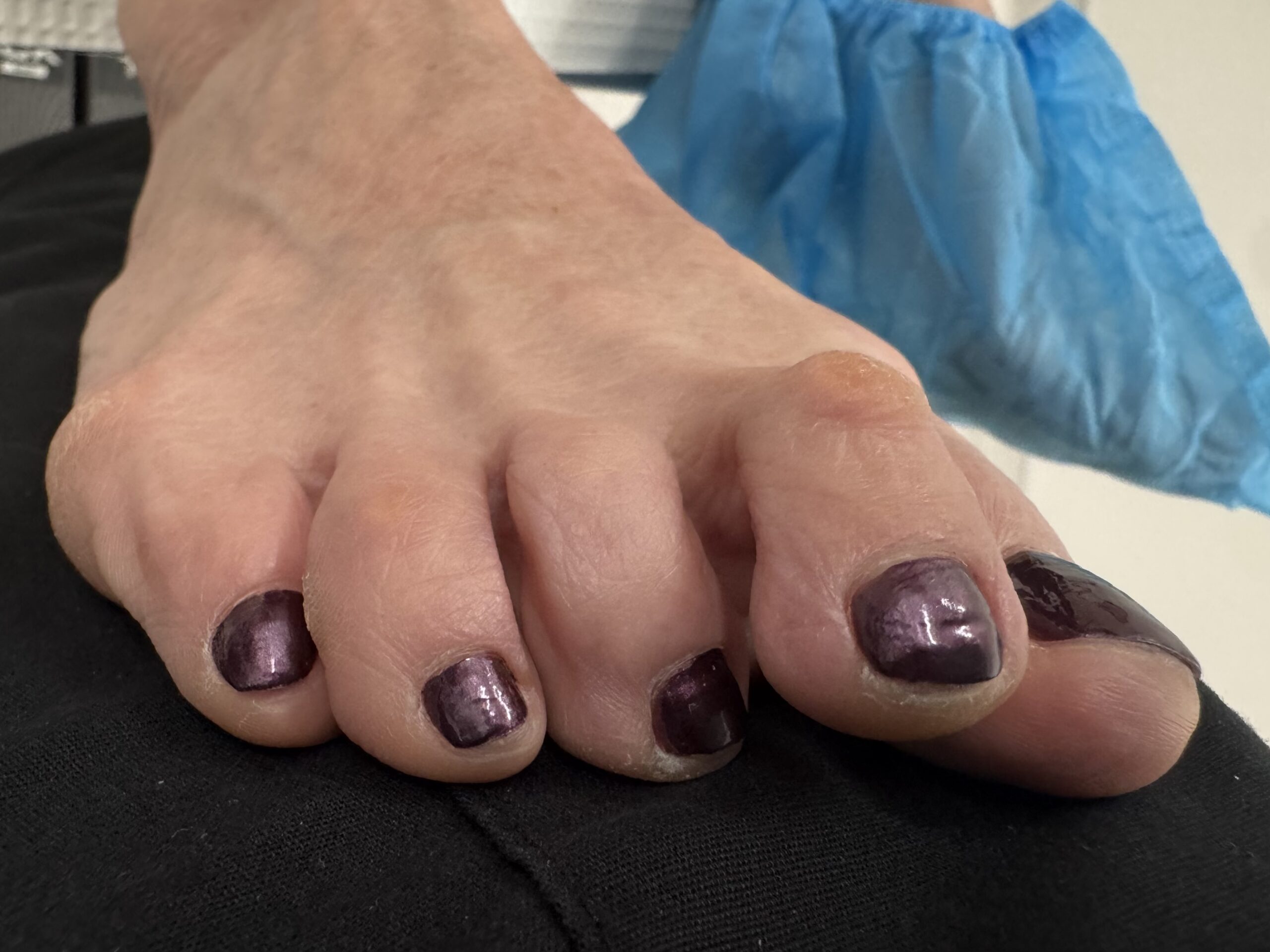 Severe Bunion Before and After Photos | Northwest Surgery Center