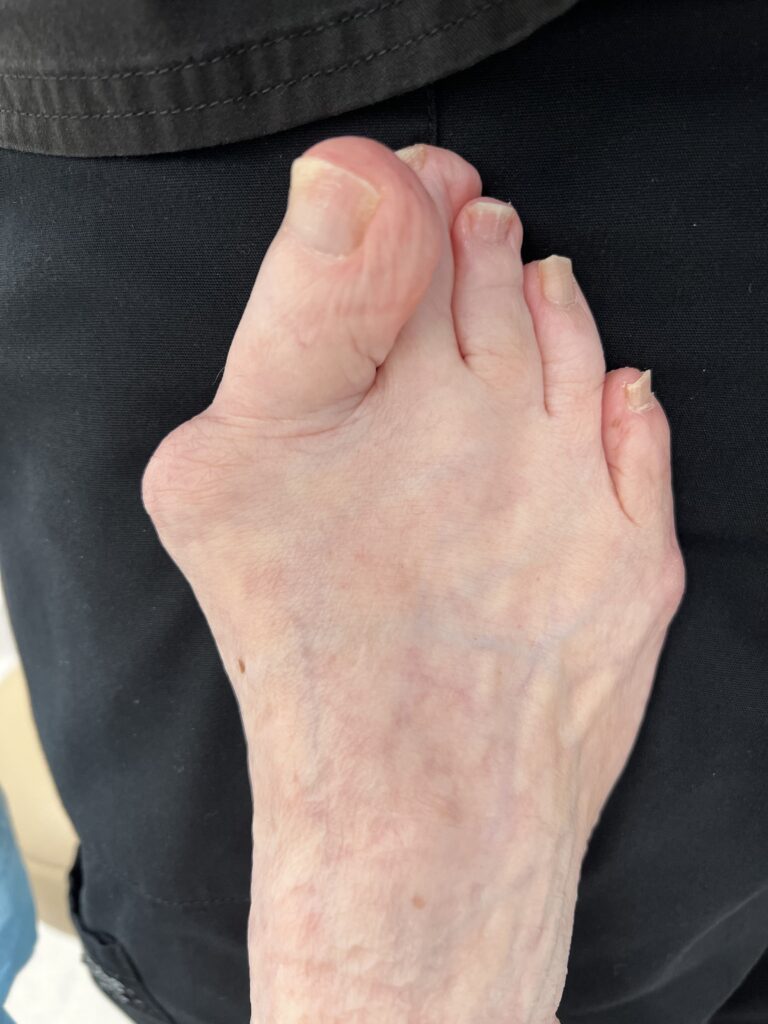Severe Bunion Before and After Photos | Northwest Surgery Center