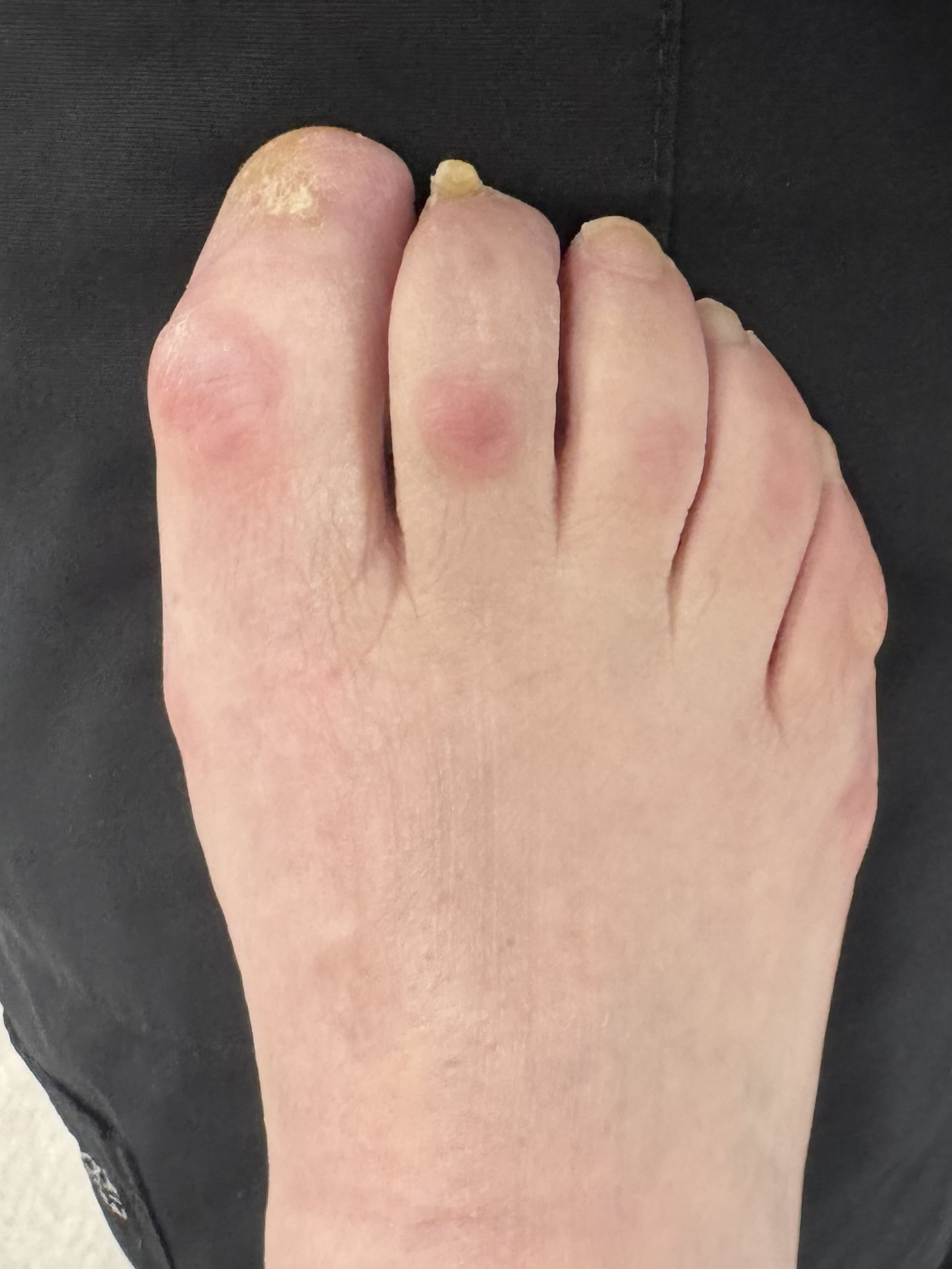 Mallet Toe Before and After Photos | Northwest Surgery Center