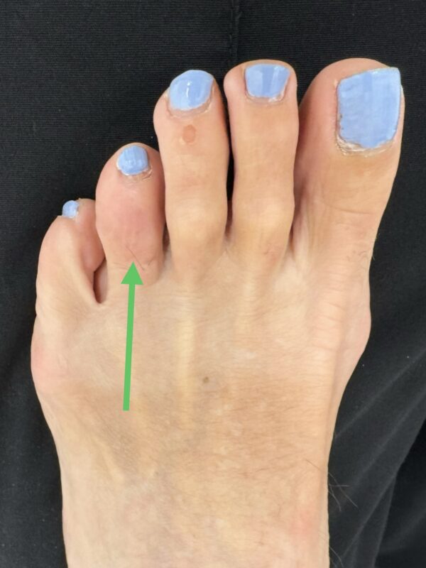 Mallet Toe Before and After Photos | Northwest Surgery Center