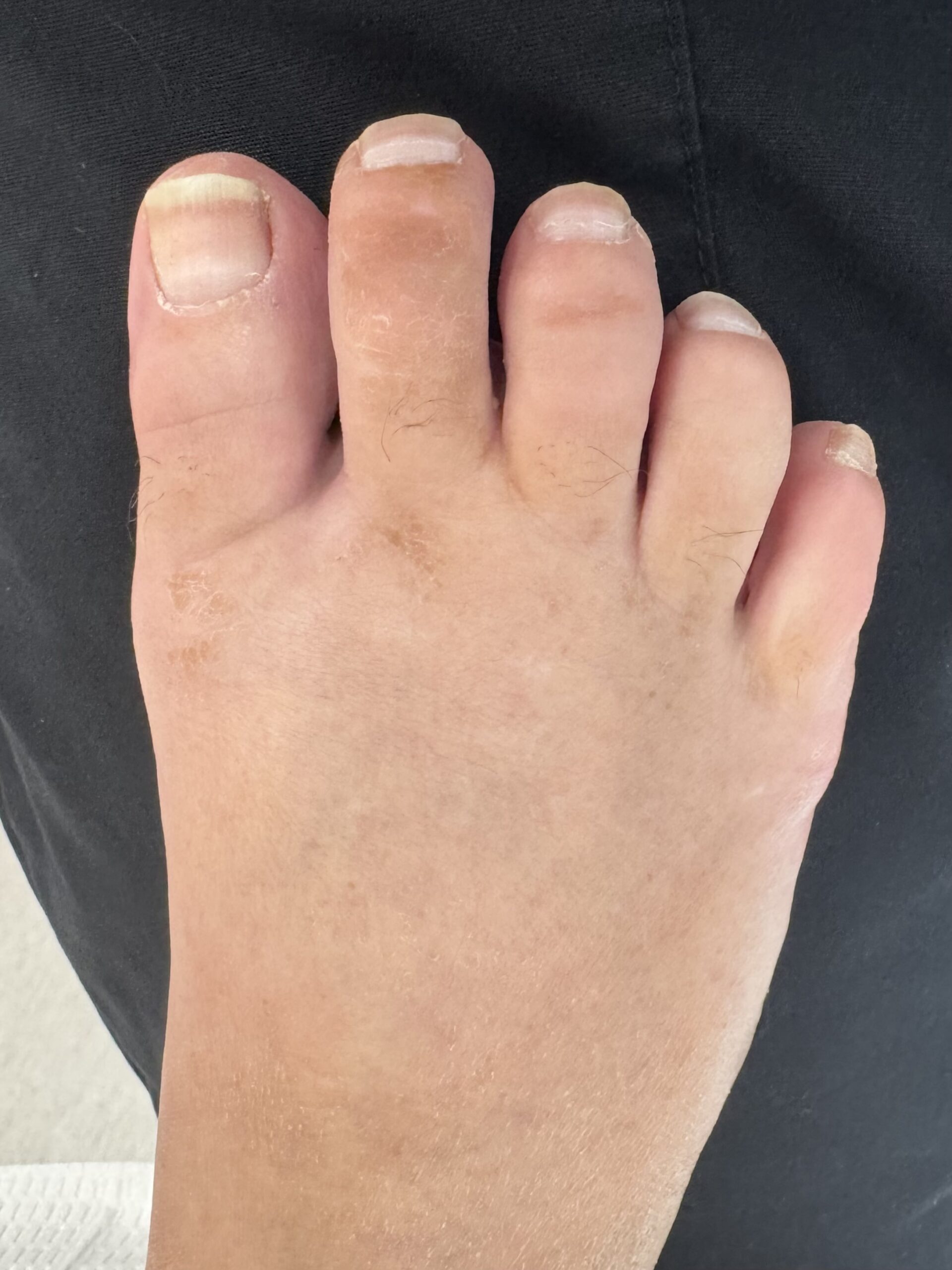 Mild Bunion Before and After Photos | Northwest Surgery Center