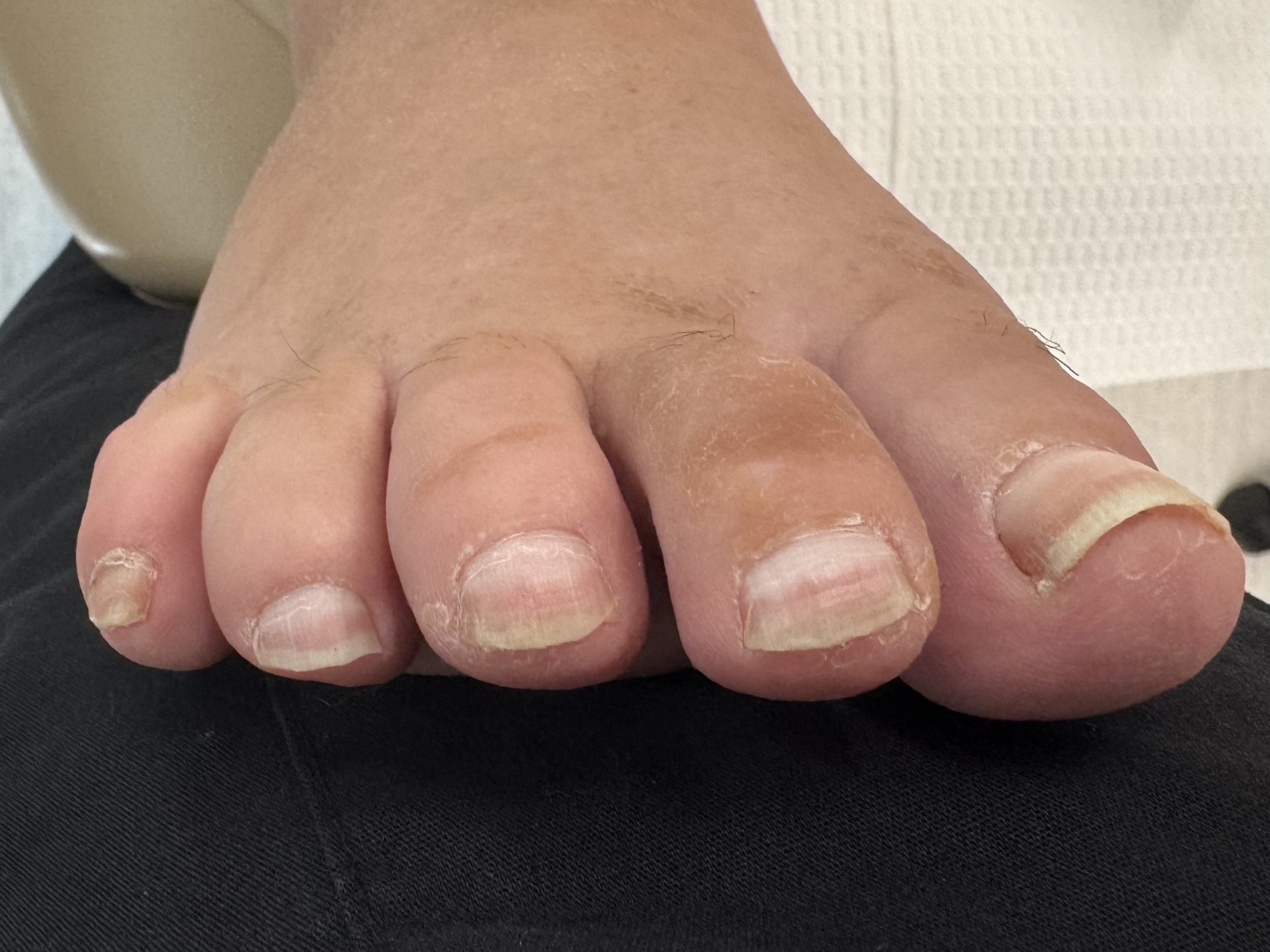 Mild Bunion Before and After Photos | Northwest Surgery Center