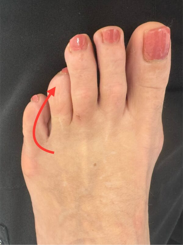 Mallet Toe Before and After Photos | Northwest Surgery Center