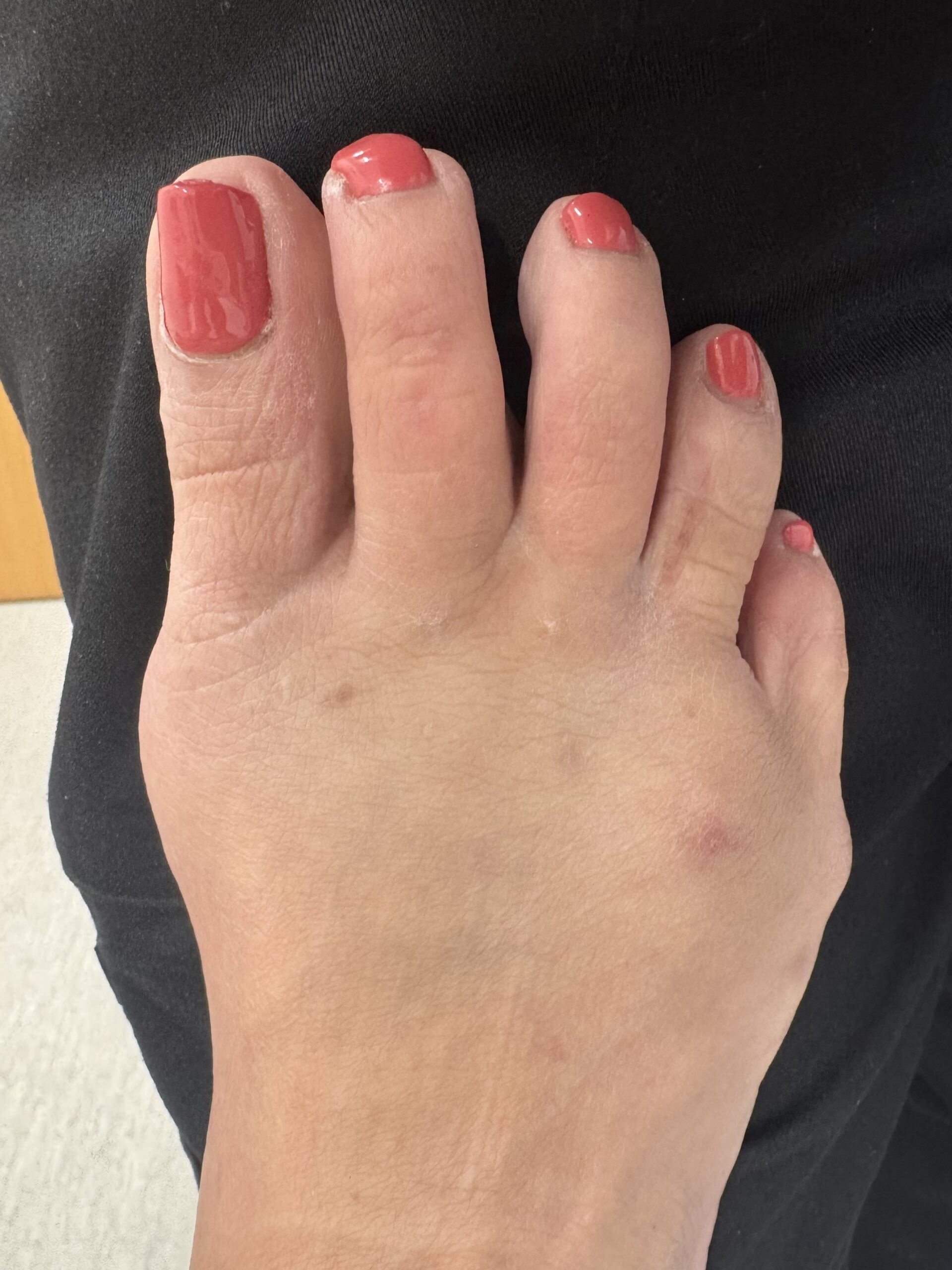 Severe Bunion Before and After Photos | Northwest Surgery Center