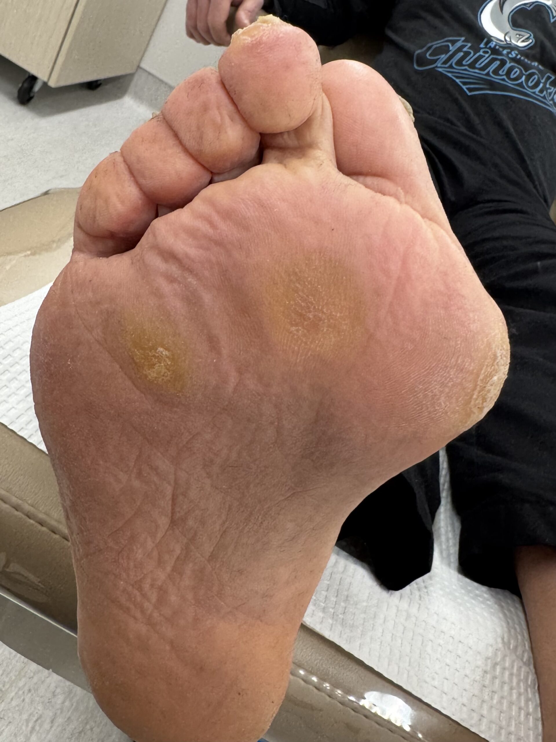 Extreme Bunion Before and After Photos | Northwest Surgery Center