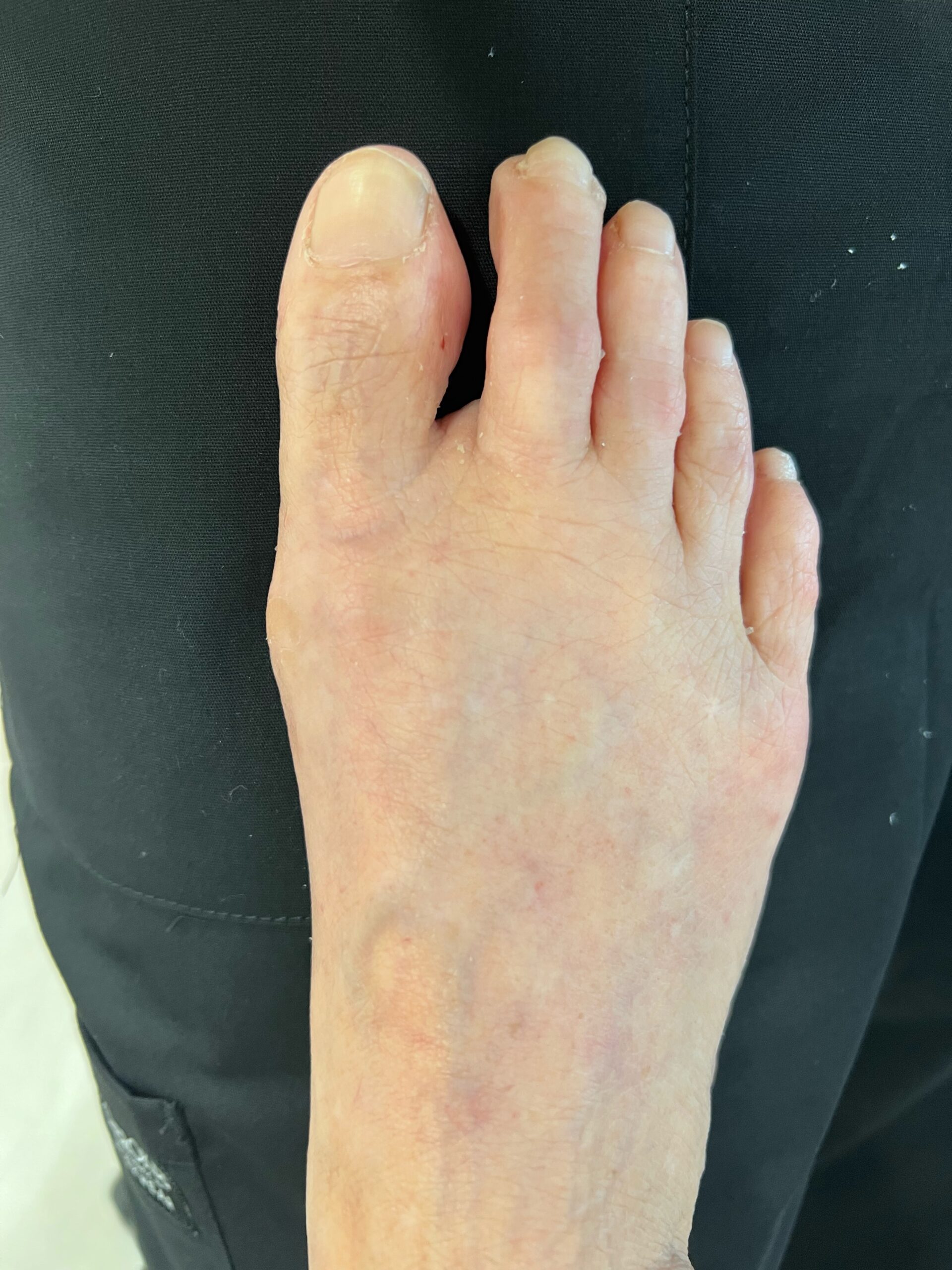 Mild Bunion Before and After Photos | Northwest Surgery Center
