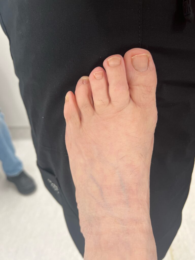Bunion Before and After Photos | Northwest Surgery Center