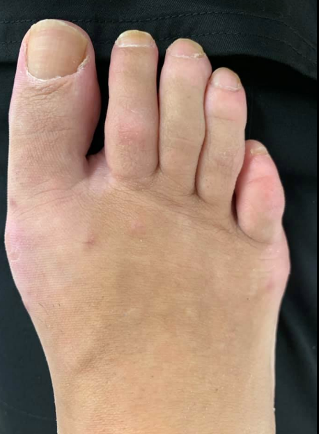 Bunion Surgery Before and After | Northwest Surgery Center Wisconsin